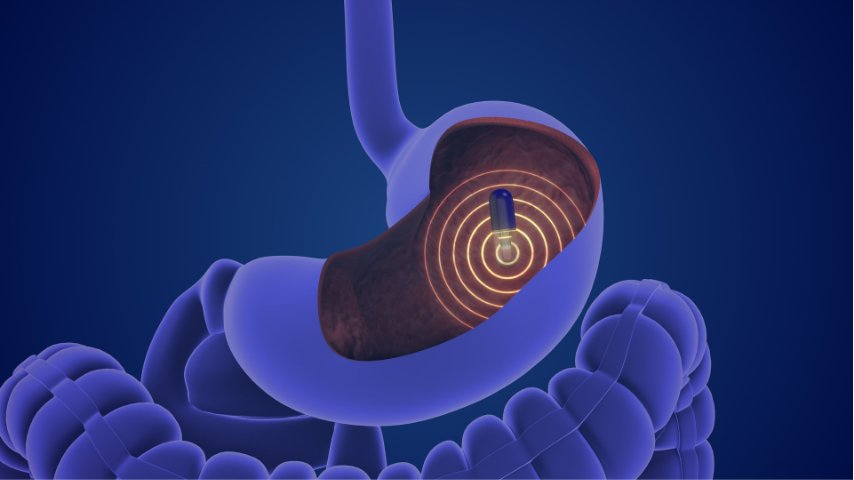 Can Capsule Endoscopy Detect Crohn's Disease When Colonoscopy Misses It?